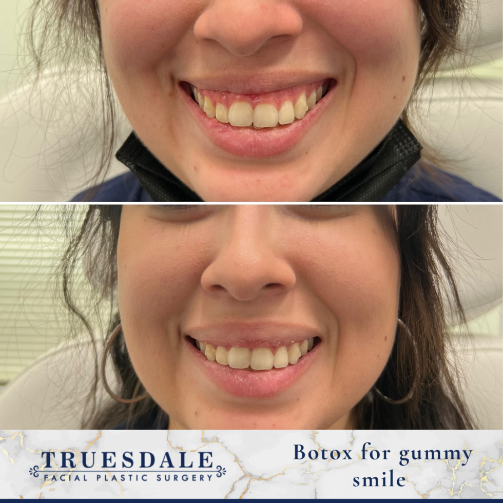 Wrinkle Treatment Beverly Hills | Truesdale Facial Plastic Surgery